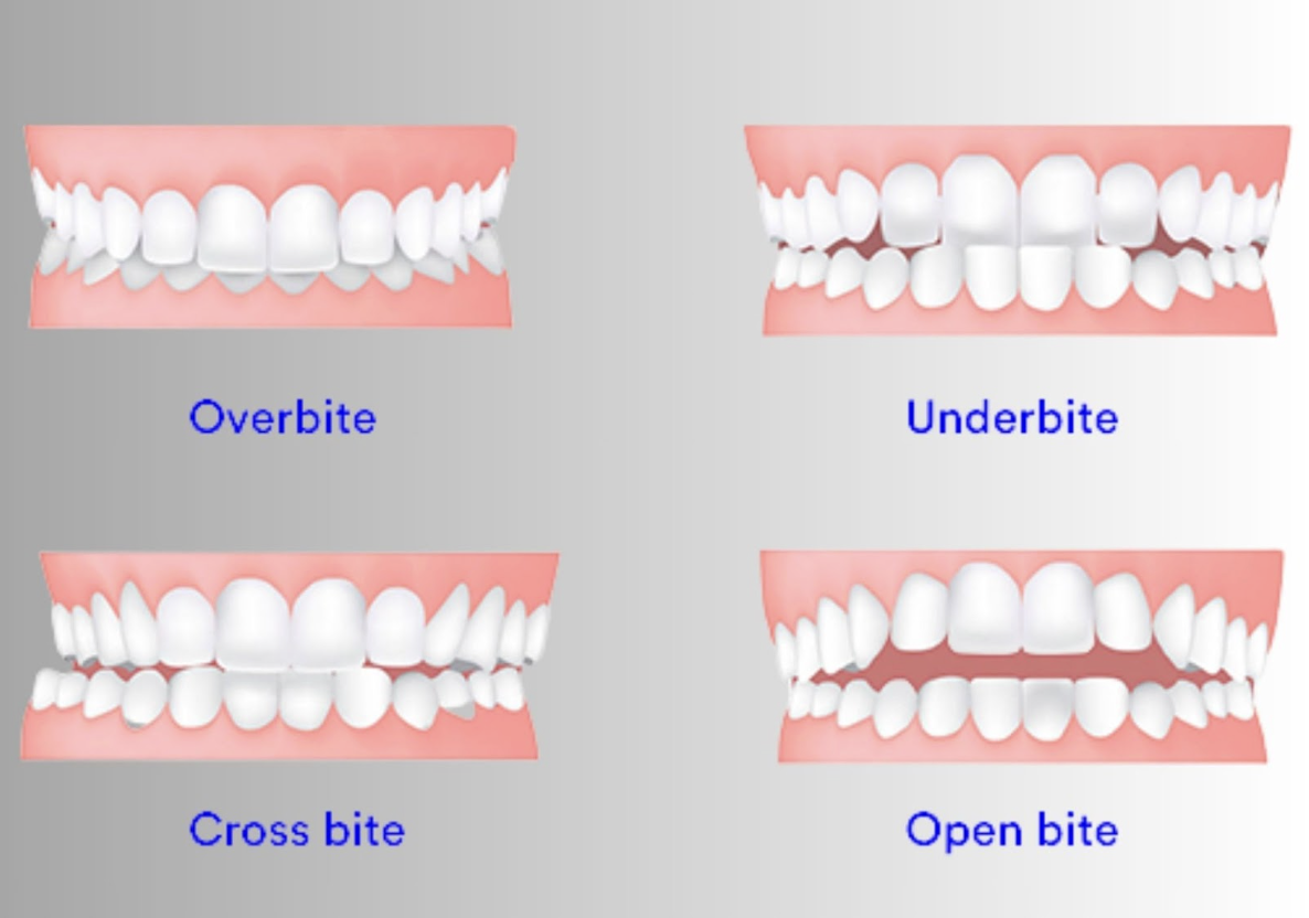 How to Mew with Overbite, Underbite, Crossbite, and Open Bite?